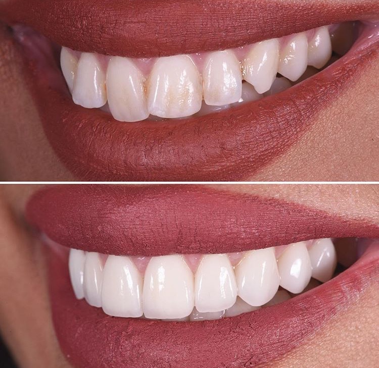 Smile Makeover - Eternal Smiles Dental Centre